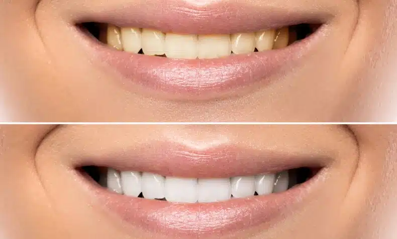 Tooth Discoloration: Causes and Treatment Options